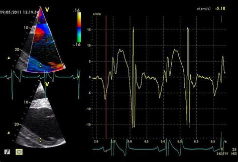 Tissue Doppler Velocity Curve Generated In The Left Ventricular Free