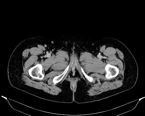 Radiopaedia Case Sex Reassignment Surgery Id Study NC Commons
