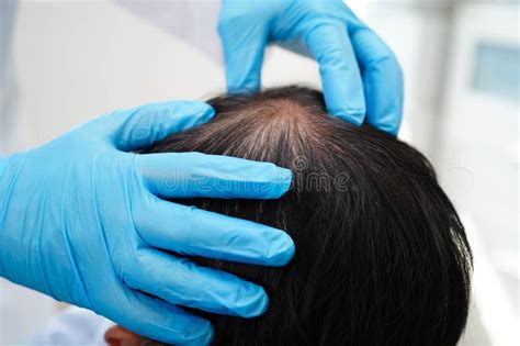 Doctor Touch Bold Head In Man Hair Loss Treatment Health Problem Stock