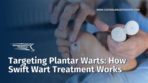 Targeting Plantar Warts How Swift Wart Treatment Works
