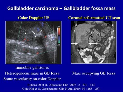 Ultrasound Of The Gallbladder