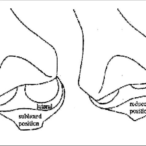 6 Illustration Of The Tibia Subluxed And After Its Sudden Reduction