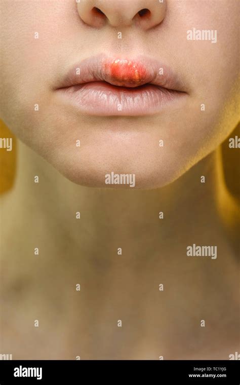 Herpes On The Upper Lip Of A Young Woman Medical Background Of A Young