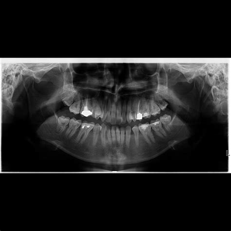 Dentalcariespanaromicxrays Object Detection Dataset And Pre Trained