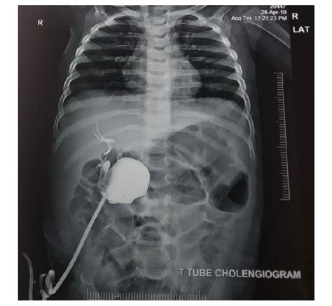 T Tube Cholangiogram Download Scientific Diagram