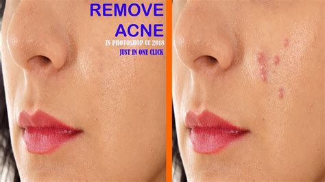 How To Remove Acne In Photoshop L Tutorials Tuts YouTube