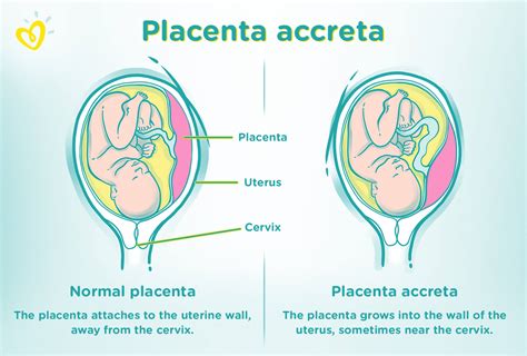 Placenta Previa What It Is Types Causes And Treatment 59 Off