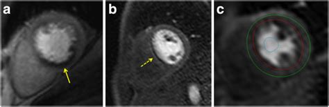 Perfusion Imaging A Perfusion Defect In The Inferior Segments Yellow