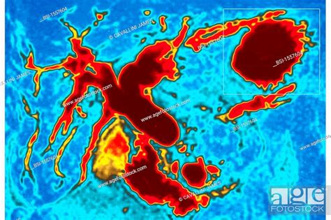 Cancer Of The Pancreas Pancreatic Cancer Intravenous Cholangiography