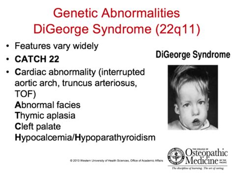 Digeorge Syndromewhat To Know
