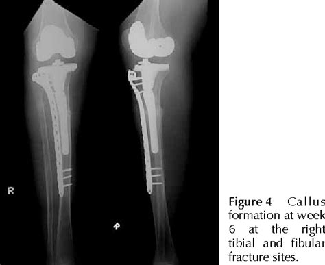 Figure 4 From Insufficiency Fracture Of The Proximal Fibula And Then