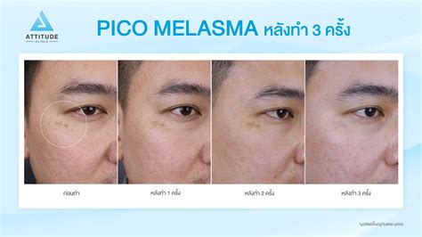 ก่อนและหลังทำเลเซอร์ Pico Laser ต้องปฏิบัติตัวอย่างไรบ้าง ให้ผลลัพธ์ออกมาดีที่สุด Attitude