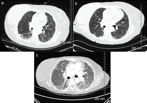 Atypical Presentation And Progression Of Scleroderma Associated