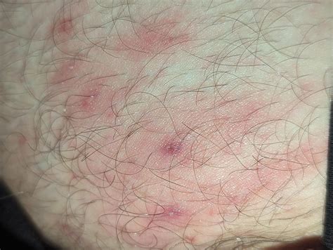 Cellulitis Rmedicaladvice