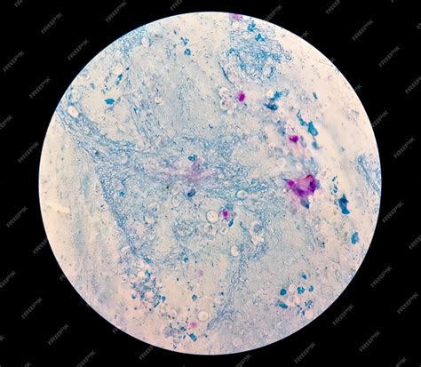 Premium Photo Sputum Smear Under Microscopy Showing Gram Positive