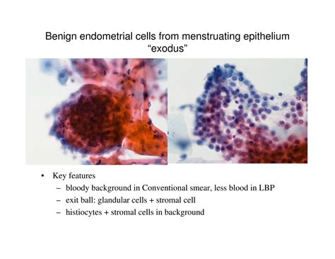 Glandular Lesions Cytology In Cervical Cytology Pdf