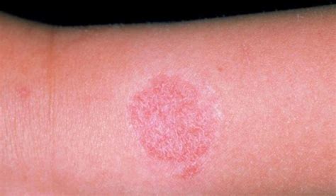 Why Dry Skin Rash On Legs Nose Genitals Or Eyes Skincarederm