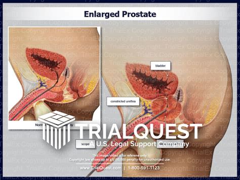Enlarged Prostate