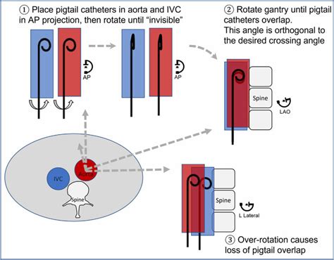 Finding Emergency Transcaval Access Projection Angles Without Ct Download Scientific Diagram