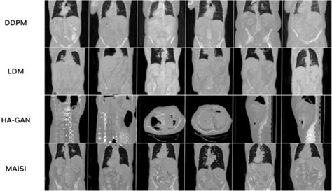Addressing Medical Imaging Limitations With Synthetic Data Generation Nvidia Technical Blog