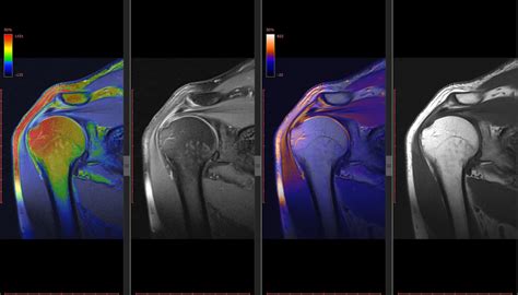 What Is A Shoulder Mri Arthrogram