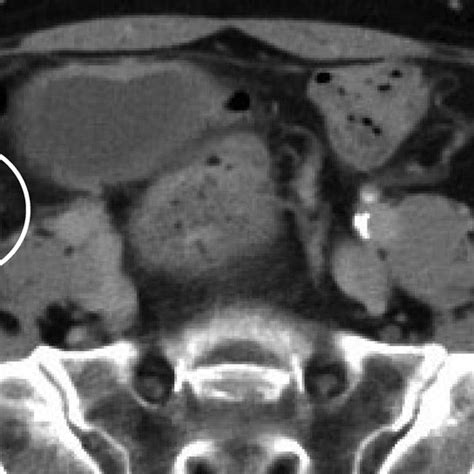 Day 2 Findings The Appendix Was Swollen And Fecaliths Were Observed Download Scientific