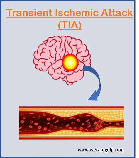 Stroke Types Symptoms Treatment Complications We Care