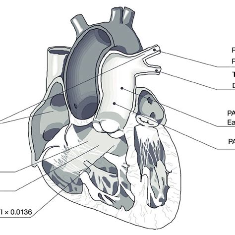 Hemodynamic Indices In Ph Papp Spap − Dpap Pvr Pulmonary