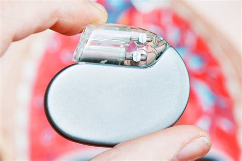 Implantable Cardioverter Defibrillator Device Abbott Receives Us Fda