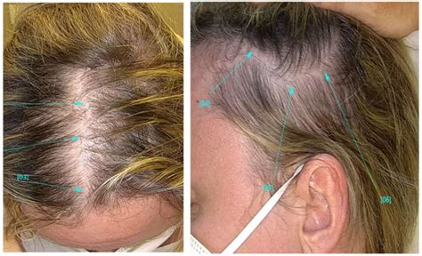 Diffuse Alopecia Areata Causes Symptoms And Treatment