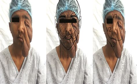 Pigmentation In Plexiform Neurofibroma Following Blaschkos Lines A