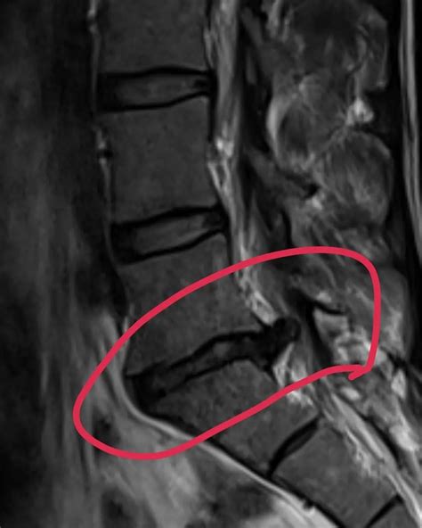 Sciatica And Cymbalta R Sciatica