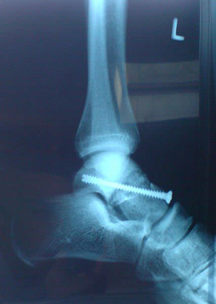 Talus Fracture