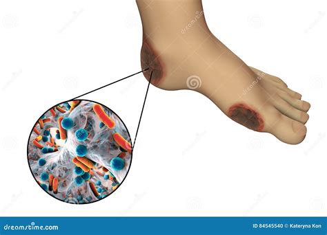 Diabetic Foot Infection With Close Up View Of Bacteria Stock