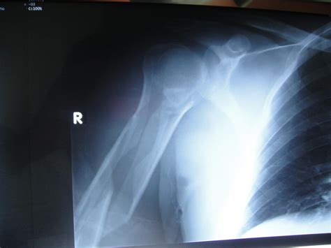 Proximal Humerus Fractures Trauma Orthobullets