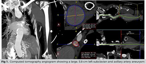 Figure 1 From Hybrid Aortobrachial Bypass For A Giant Subclavian And