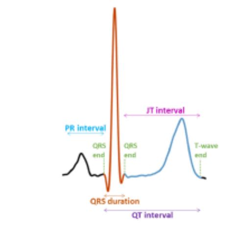 spatial qrs t angles to indicate cvd risk ecg excellence