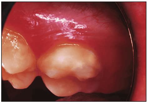 Smooth Surface Dental Caries And Decalcification Restoration And Reinforced Sealant Application