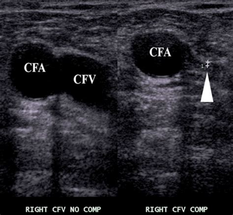 E1 Cpss Pocus Dvt And Skinsoft Tissues Flashcards Quizlet