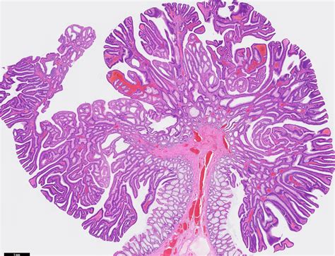 Pathology Outlines Tubulovillous Villous Adenoma