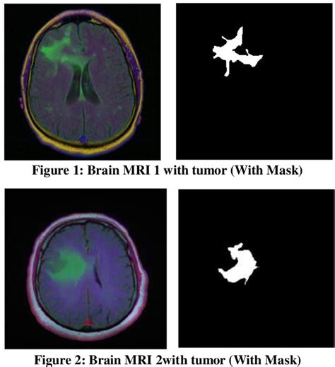Figure 1 From Brain Tumor Detection And Segmentation Using Deep Learning Semantic Scholar