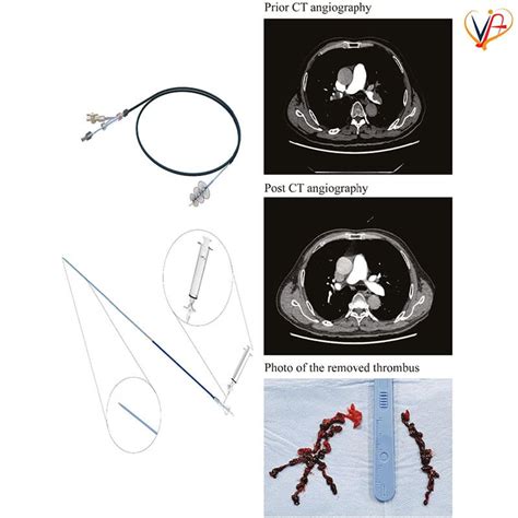A Large Diameter Thrombus Retrieving Device For Intermediate Risk Acute