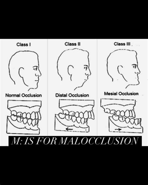 🦷m🦷 Is For Malocclusion Defined Harrington Orthodontics