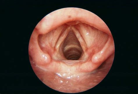 Hpv In The Throat
