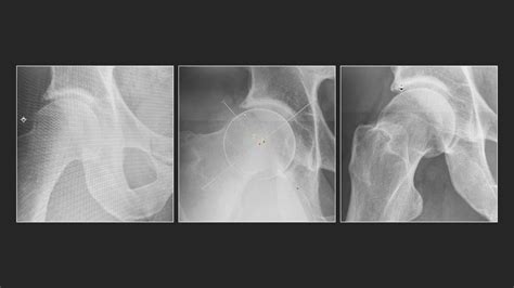 Arthrex Primary Acetabular Labral Reconstruction Case Presentation