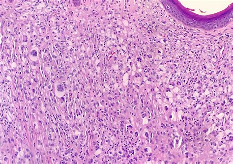 Juvenile Xanthogranuloma Histology Juvenile Xanthogranuloma Histology