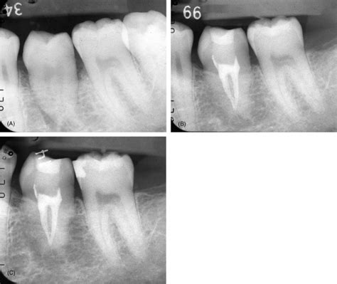 Replacement Resorption Gaylord Mi Otsego Endodontics