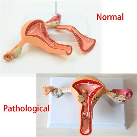 Normal Uterus