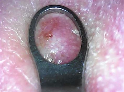 Behind The Ear Abscess Chunky Pop Follow Up From My Pus Geyser R