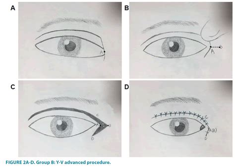 Blepharoplasty Incorporating Epicanthoplasty Using The Scar Hiding